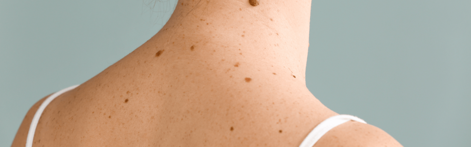 How to Remove Barnacle Spots on The Skin? | Lumenis UK