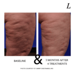 A Complete Guide to Cellulite on Legs - Lumenis UK