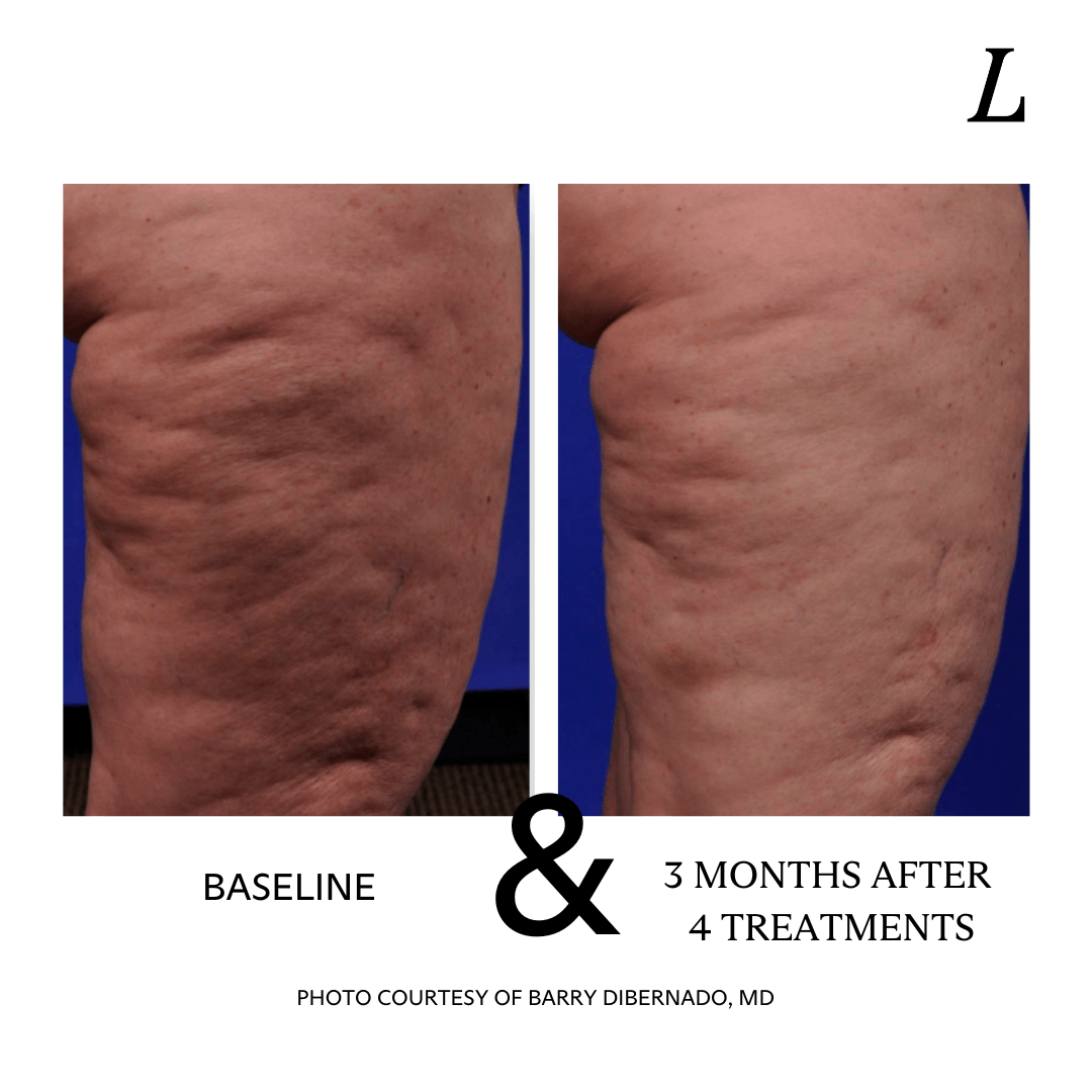 A Complete Guide to Cellulite on Legs - Lumenis UK